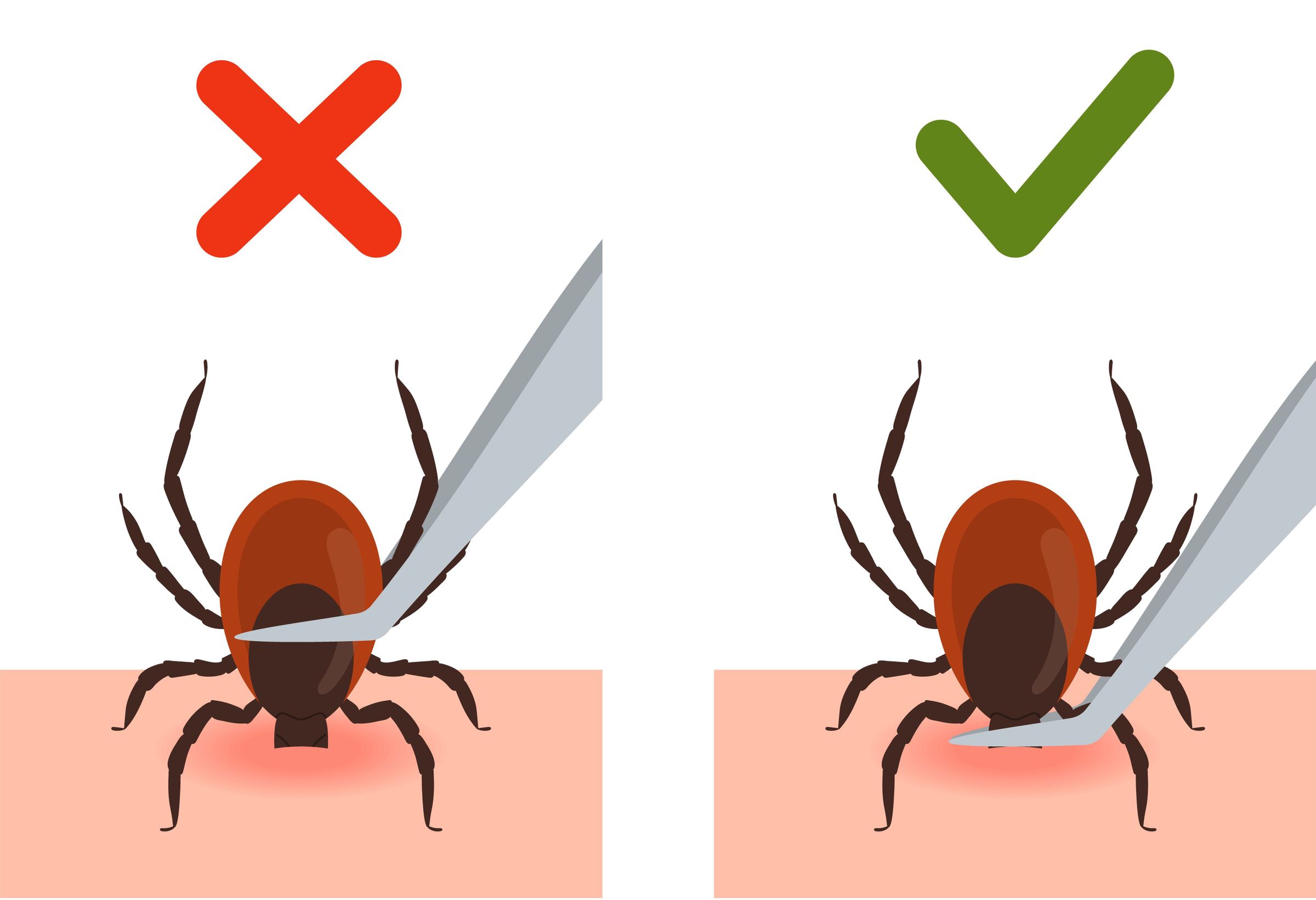 How to Remove a Tick Properly (and Avoid Ticks to Start With)
